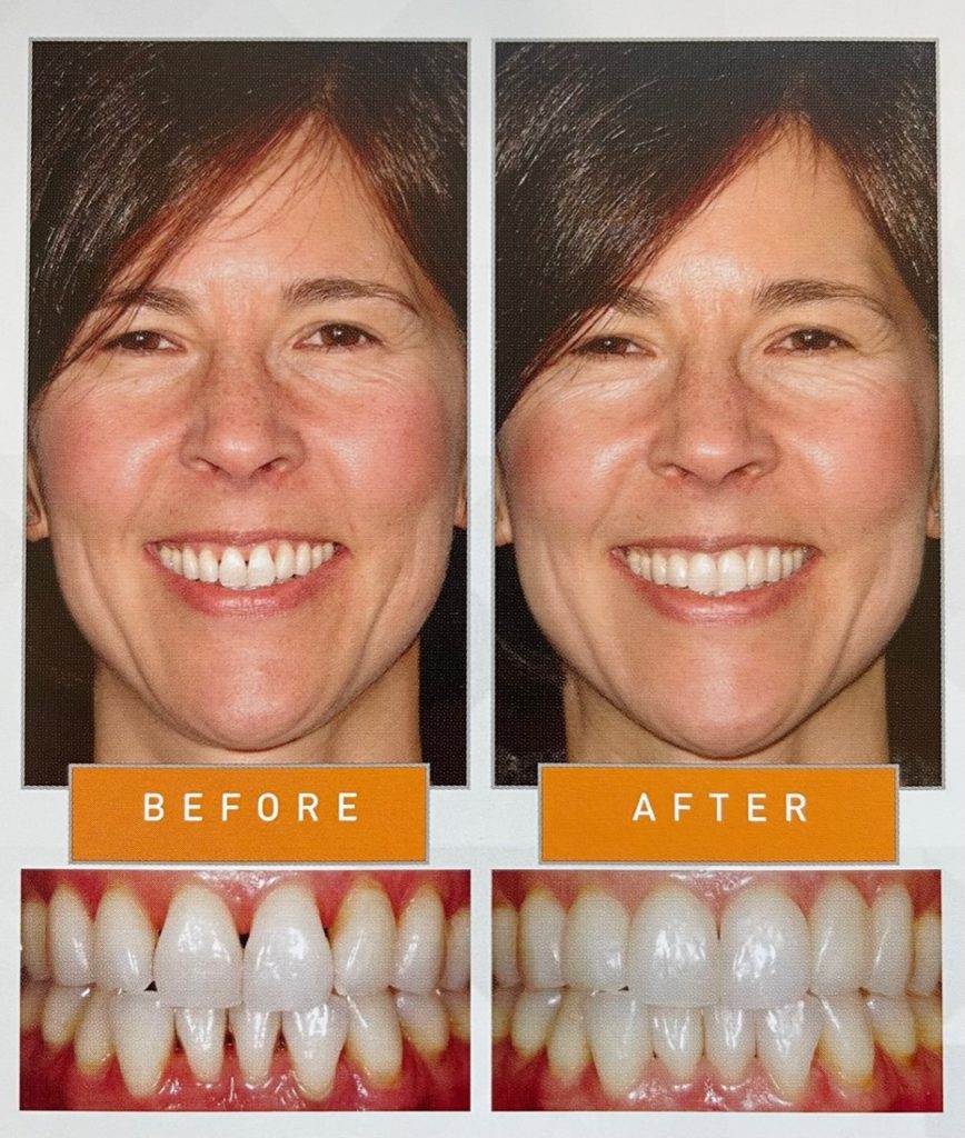 BioClear » Rivercrest Family Dental